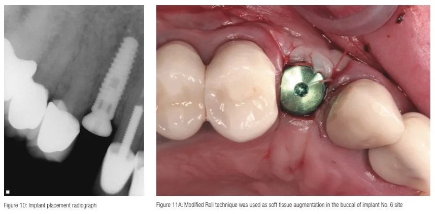Osseodensification facilitates ridge expansion with enhanced implant ...