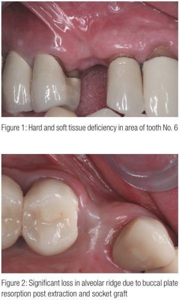 Osseodensification facilitates ridge expansion with enhanced implant ...