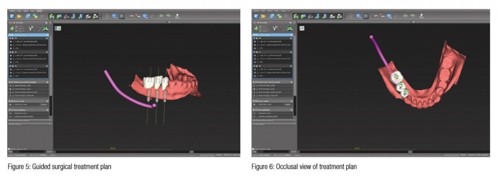 A simplified guided surgical protocol: three mandibular implants ...