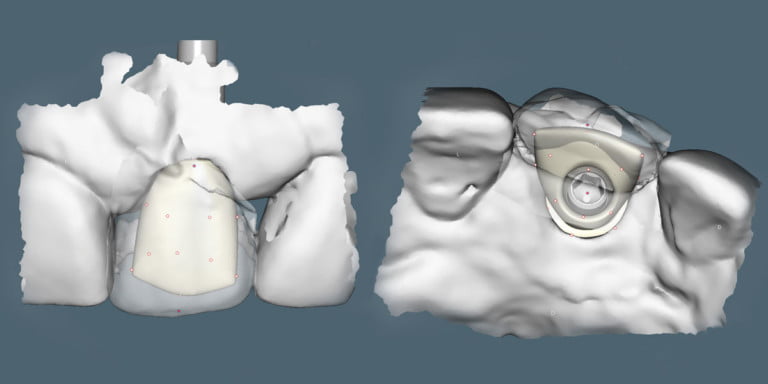 Restoring implant supported maxillary single central incisors using ...