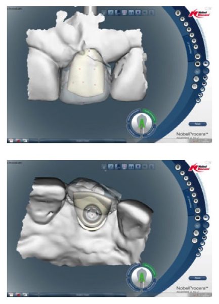 Restoring implant supported maxillary single central incisors using ...