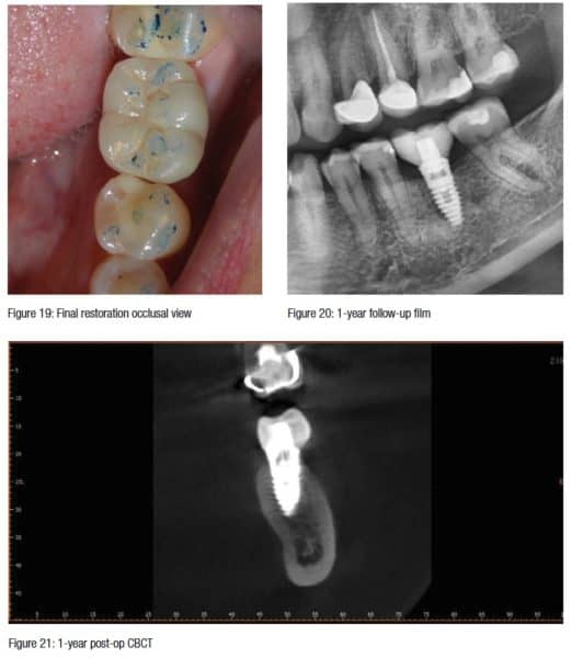 From edentulous space to walking out with a tooth: a 40-minute ...