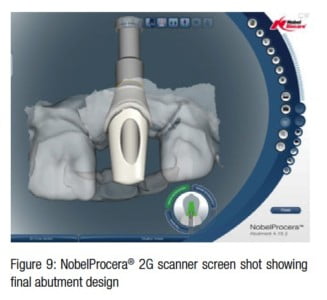 Restoring implant supported maxillary single central incisors using ...