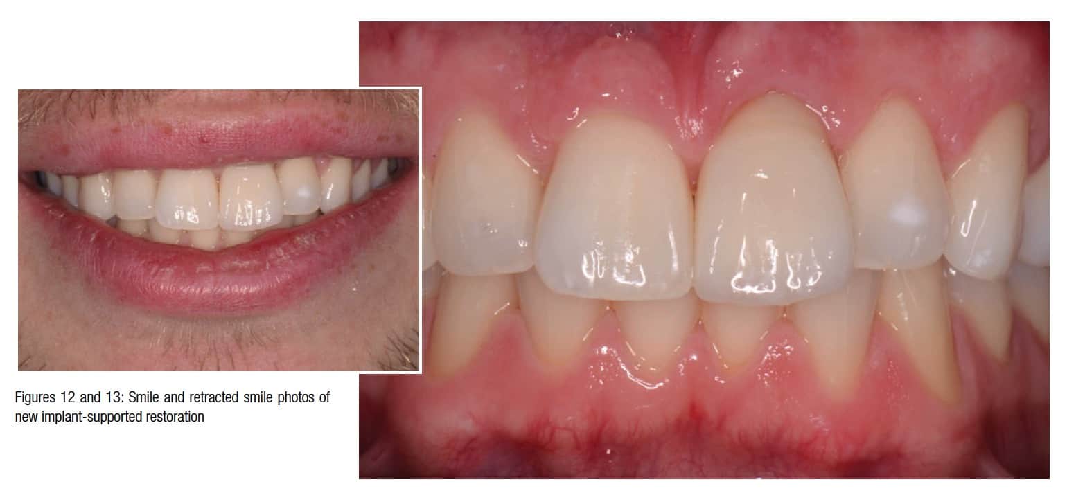 Restoring implant supported maxillary single central incisors using ...