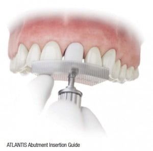 ATLANTIS™ patient-specific solutions Implant Practice US - Dental ...
