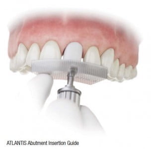 ATLANTIS™ patient-specific solutions Implant Practice US - Dental ...