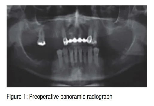 Surgery in prevention of inferior alveolar nerve damage – Implant ...