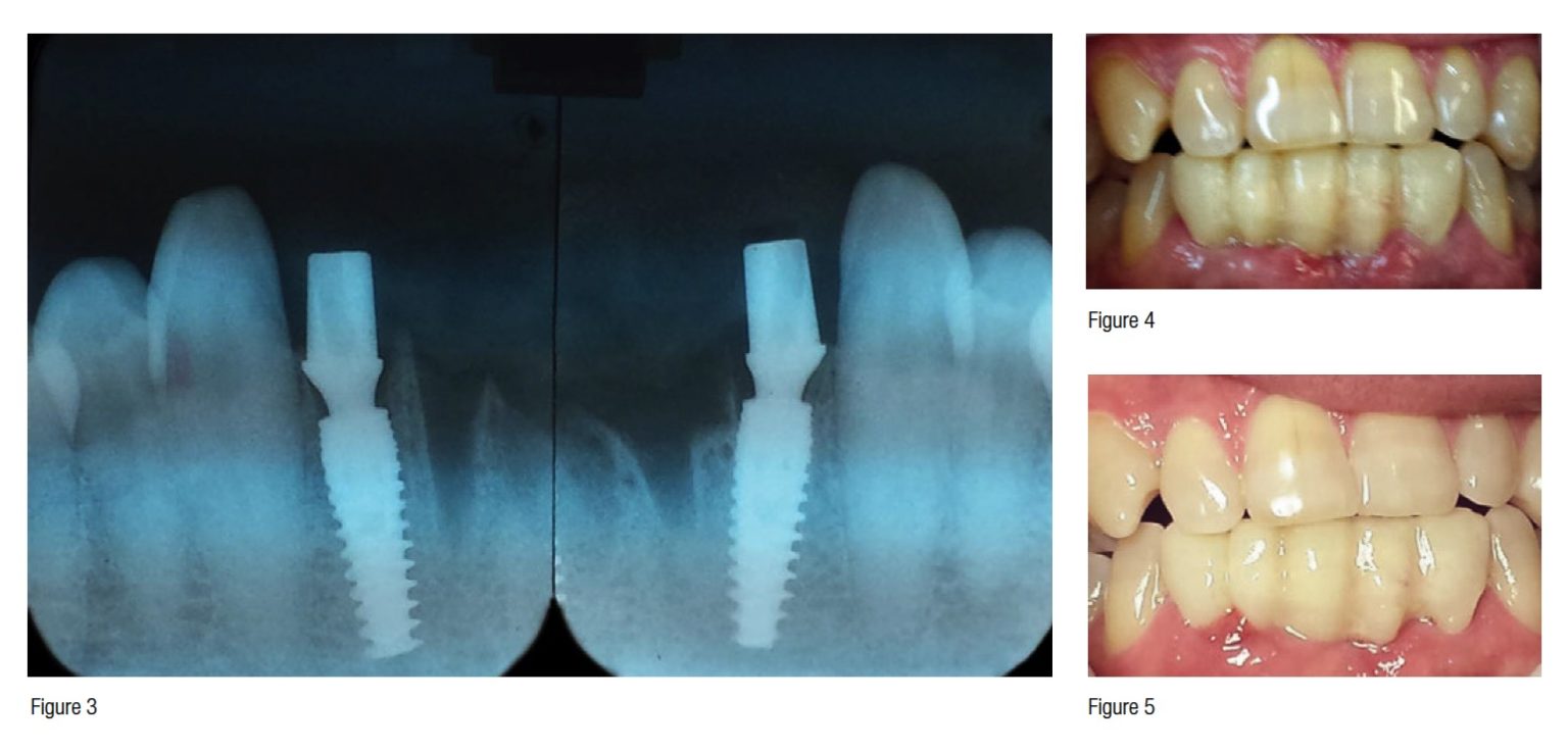 Implantology News - Post extraction, immediate placement and ...