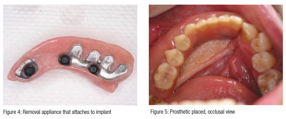 Reconstruction of resected jaw assisted by 3D technologies Implant ...
