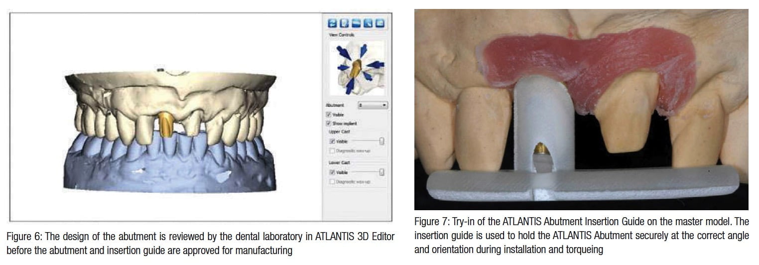 ATLANTIS™ patient-specific solutions Implant Practice US - Dental ...
