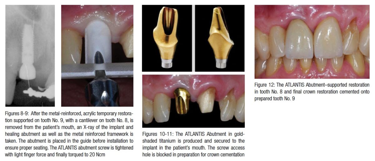 ATLANTIS™ patient-specific solutions Implant Practice US - Dental ...