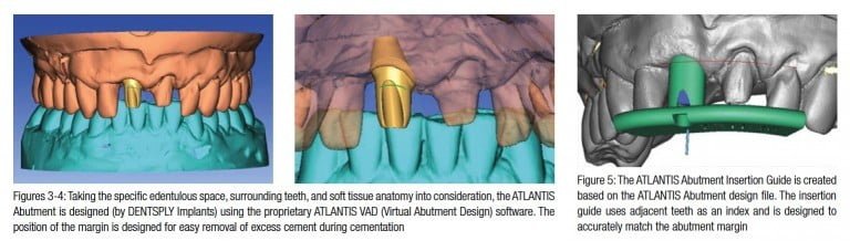 ATLANTIS™ patient-specific solutions Implant Practice US - Dental ...