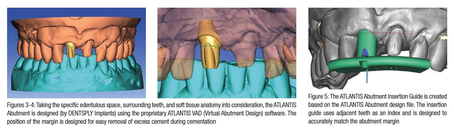 ATLANTIS™ patient-specific solutions Implant Practice US - Dental ...