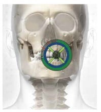 X-Guide® Dynamic 3D Navigation system Implant Practice US - Dental ...