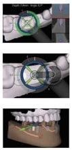 X-Guide® Dynamic 3D Navigation system Implant Practice US - Dental ...