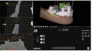 X-Guide® Dynamic 3D Navigation system Implant Practice US - Dental ...