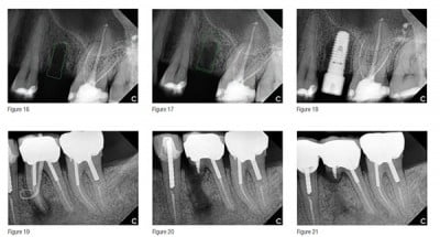 Collagen plug application in extraction sockets Implant Practice US ...
