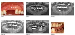 Collagen plug application in extraction sockets Implant Practice US ...