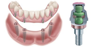LOCATOR F-Tx® fixed attachment system Implant Practice US - Dental ...