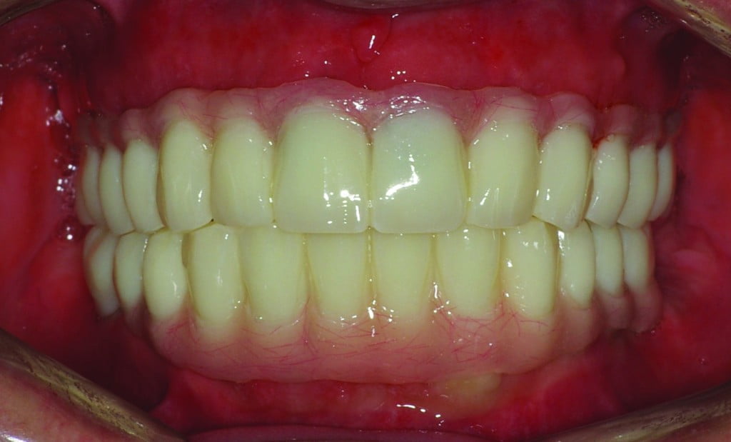 Full arch fixed provisionals with dual stabilization dental implants ...