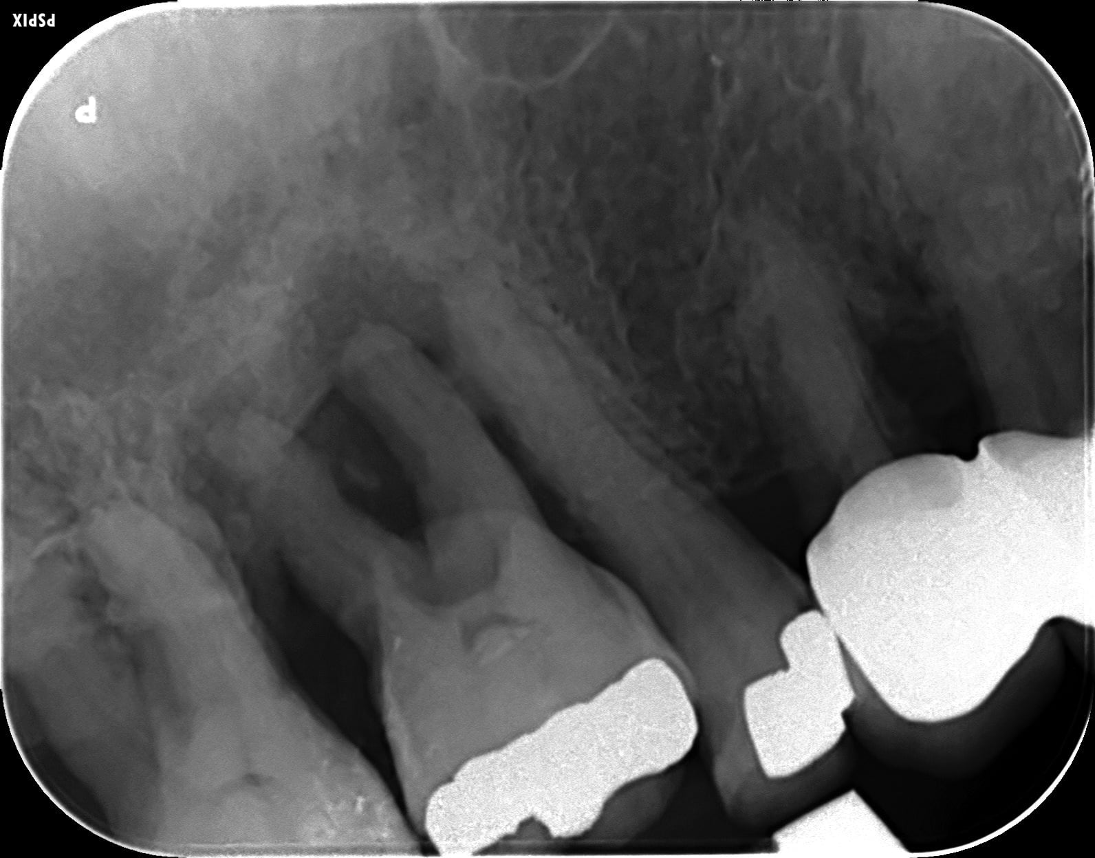 Autologous bone grafting using extracted teeth - Implant Practice US ... Autologous bone grafting using extracted teeth - Implant Practice US ...