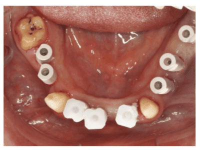 Full-arch restoration planning and treatment with 3Shape TRIOS IOS | Implant Practice US
