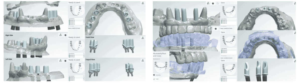 Full-arch restoration planning and treatment with 3Shape TRIOS IOS | Implant Practice US