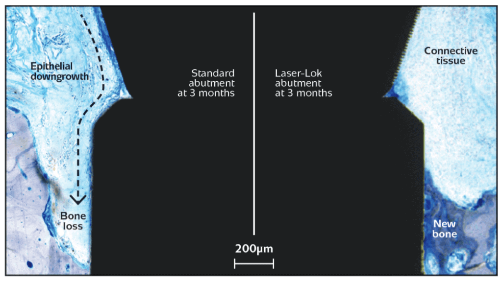Long-term case studies using a Laser-Lok® implant Implant Practice US ...