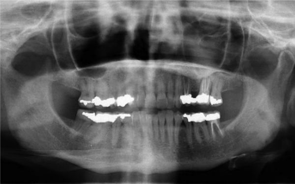 High frequency vibration device for implant success
