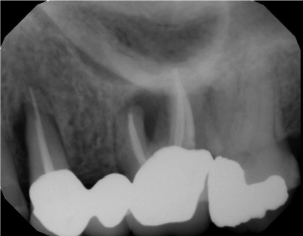 High frequency vibration device for implant success