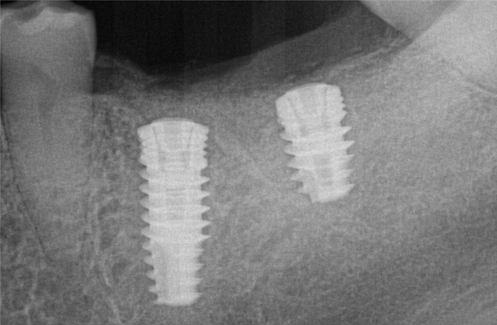 Precision is crucial in guided implant placement