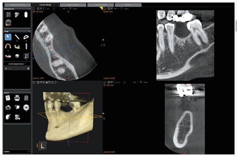Important information regarding CBCT can impact implant placement
