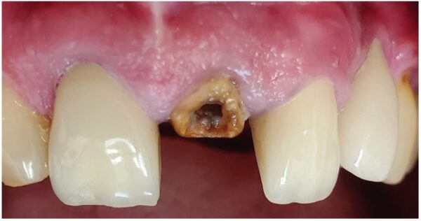 Predictable results with this screw-retained immediate restoration