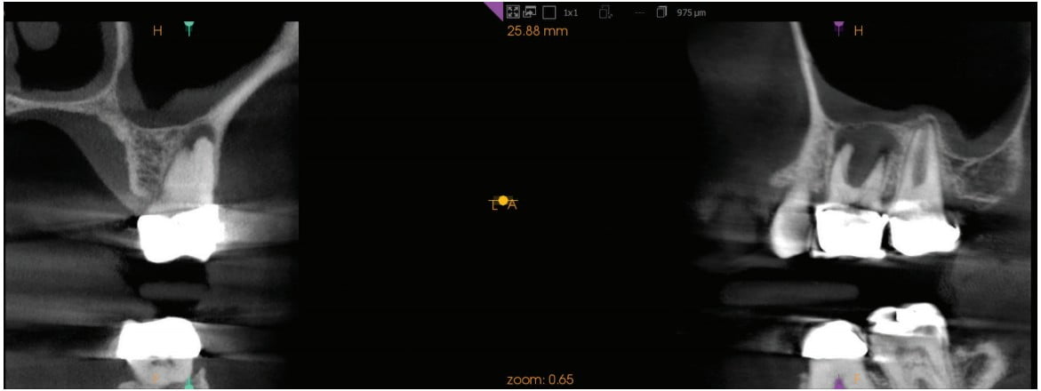 CBCT brings clarity to implant placement