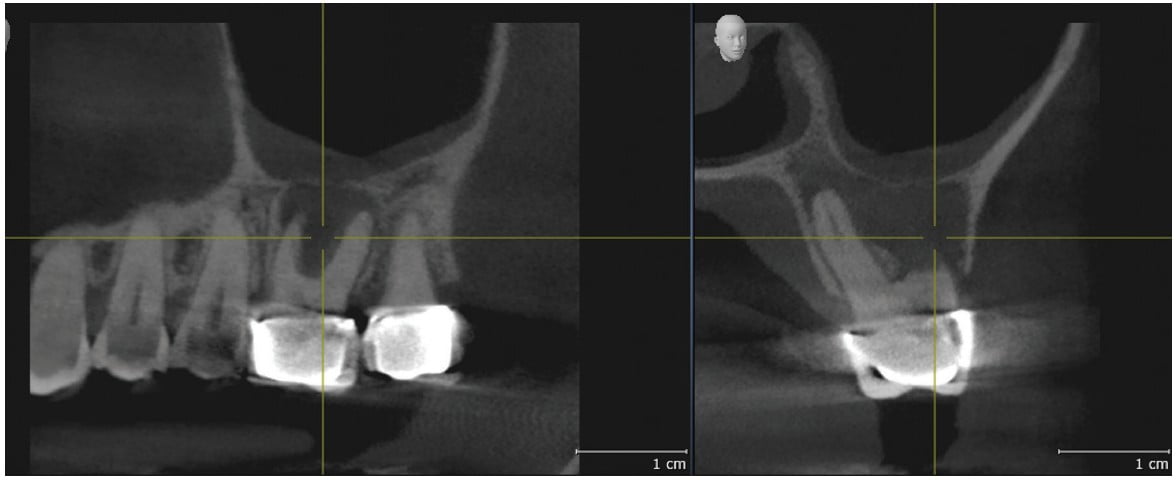 CBCT brings clarity to implant placement