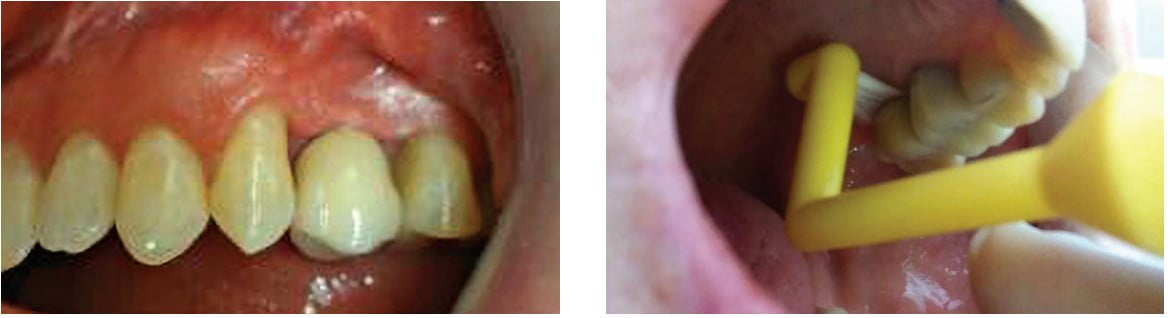 Oral hygiene — key to dental implant longevity