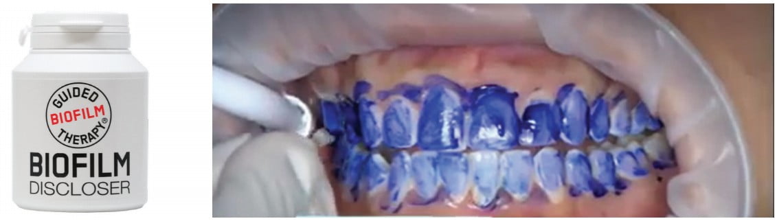 Oral hygiene — key to dental implant longevity