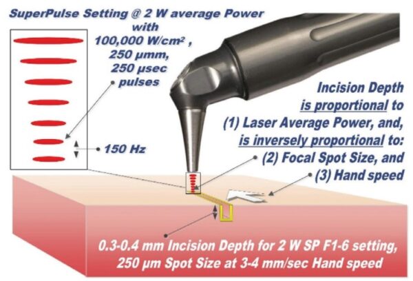 SuperPulse laser is implant safe
