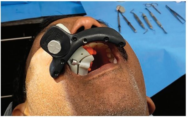 Robot-assisted implant placement — building confidence for implant ...