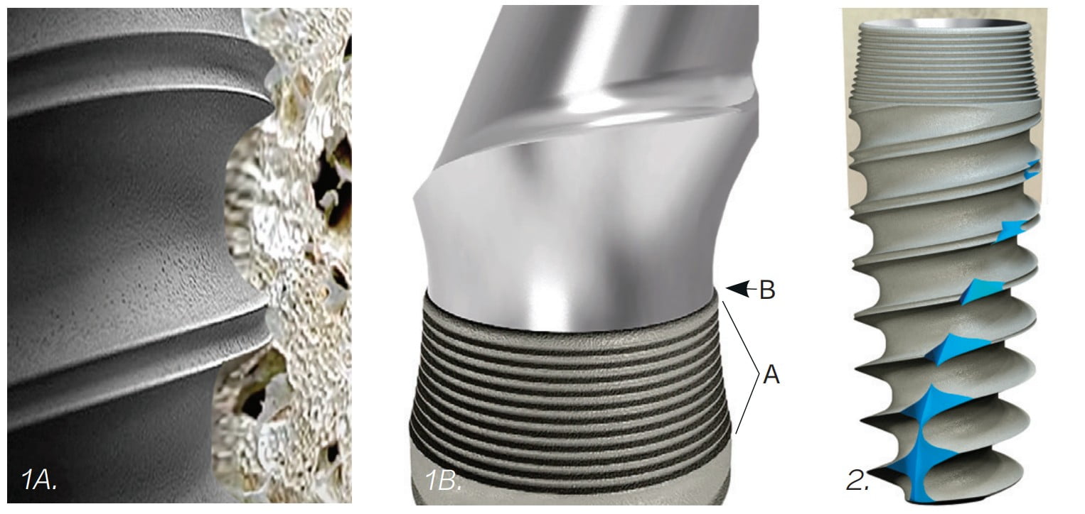 Full arch treatment and preserving crestal bone
