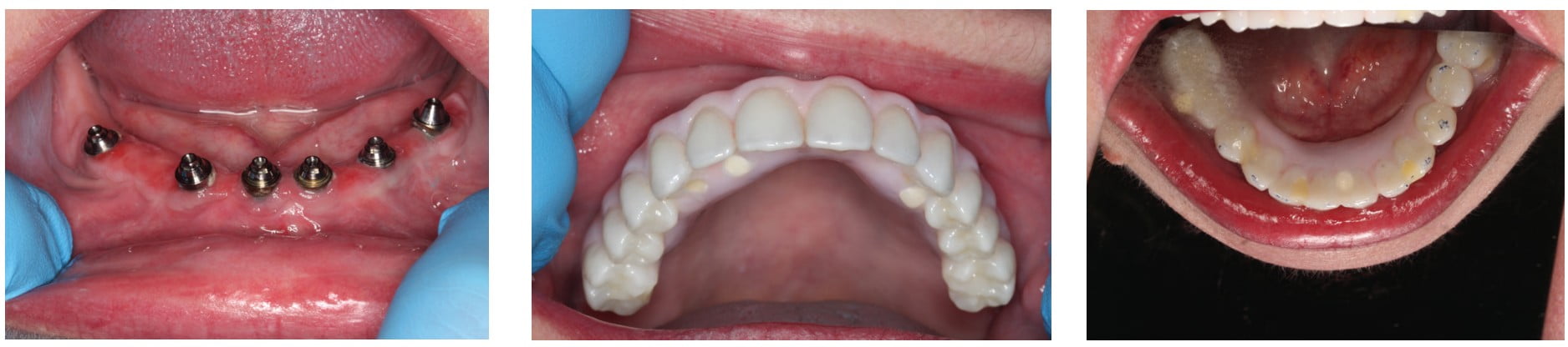 Full arch treatment and preserving crestal bone