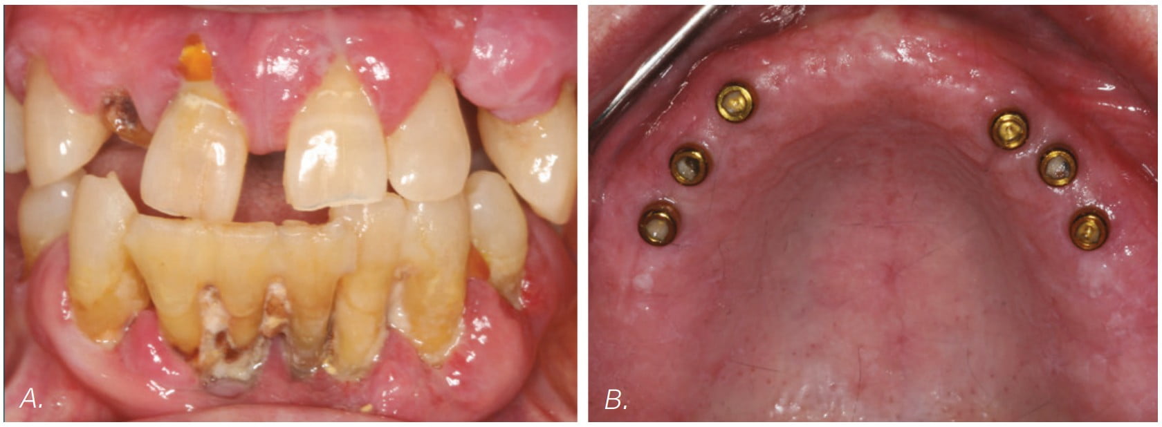LOCATOR FIXED for full-arch restorations