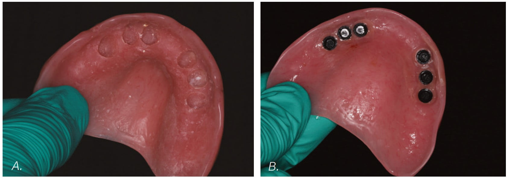 LOCATOR FIXED for full-arch restorations