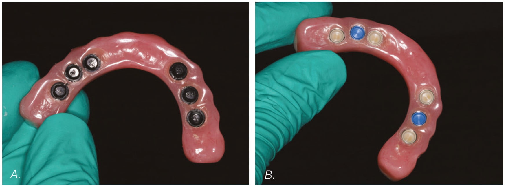 LOCATOR FIXED for full-arch restorations