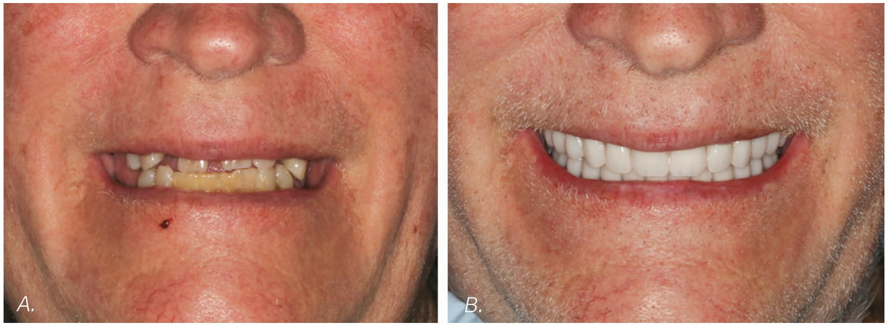 LOCATOR FIXED for full-arch restorations