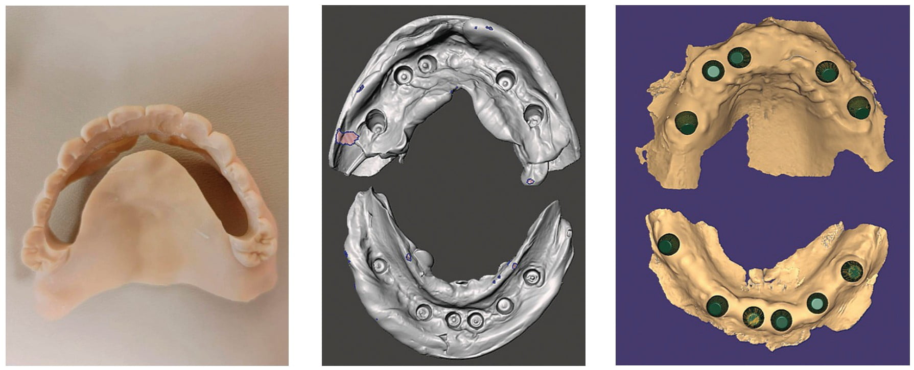 Full arch treatment and preserving crestal bone