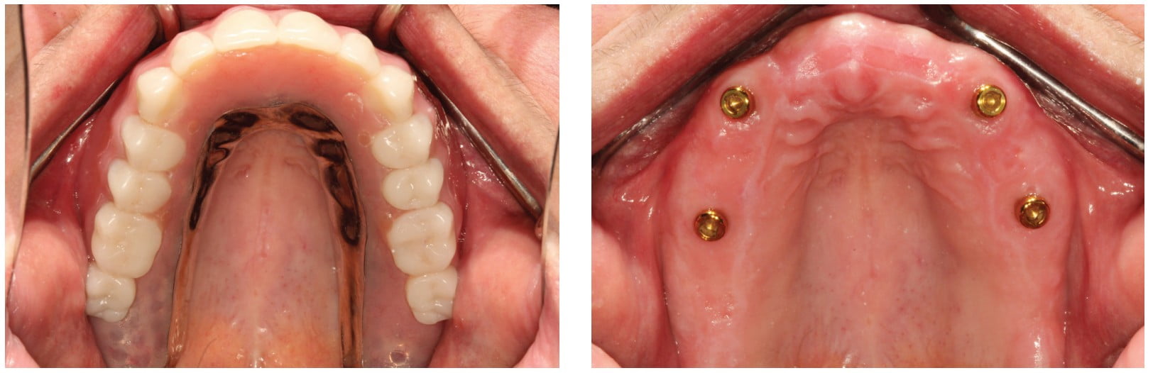 LOCATOR FIXED™ full-arch — a new distinguishing technique
