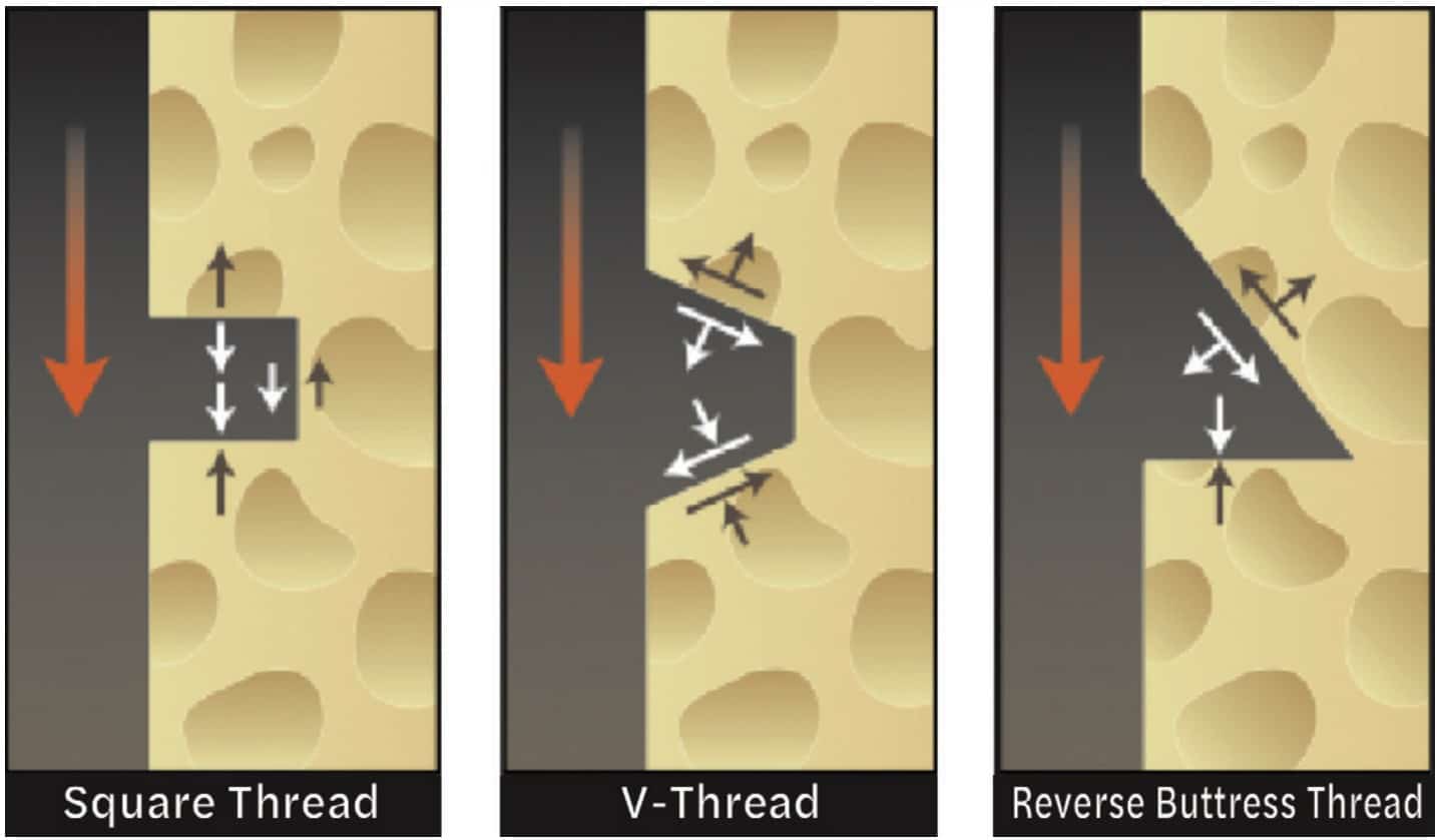 Improved implant stability — achievable with Unifi MI implant