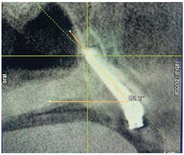 Pterygoid implants — positive survival rates