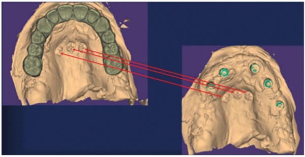 Photogrammetry — advancement in digital technology for implants